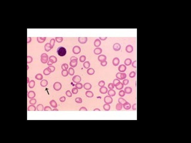Anemia of chronic diseases.ppt anemia presentation | PPT