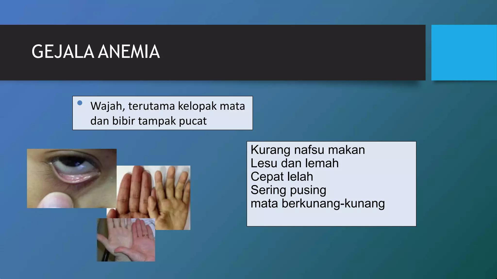 ANEMIA PADA REMAJA PUTRI.pptx