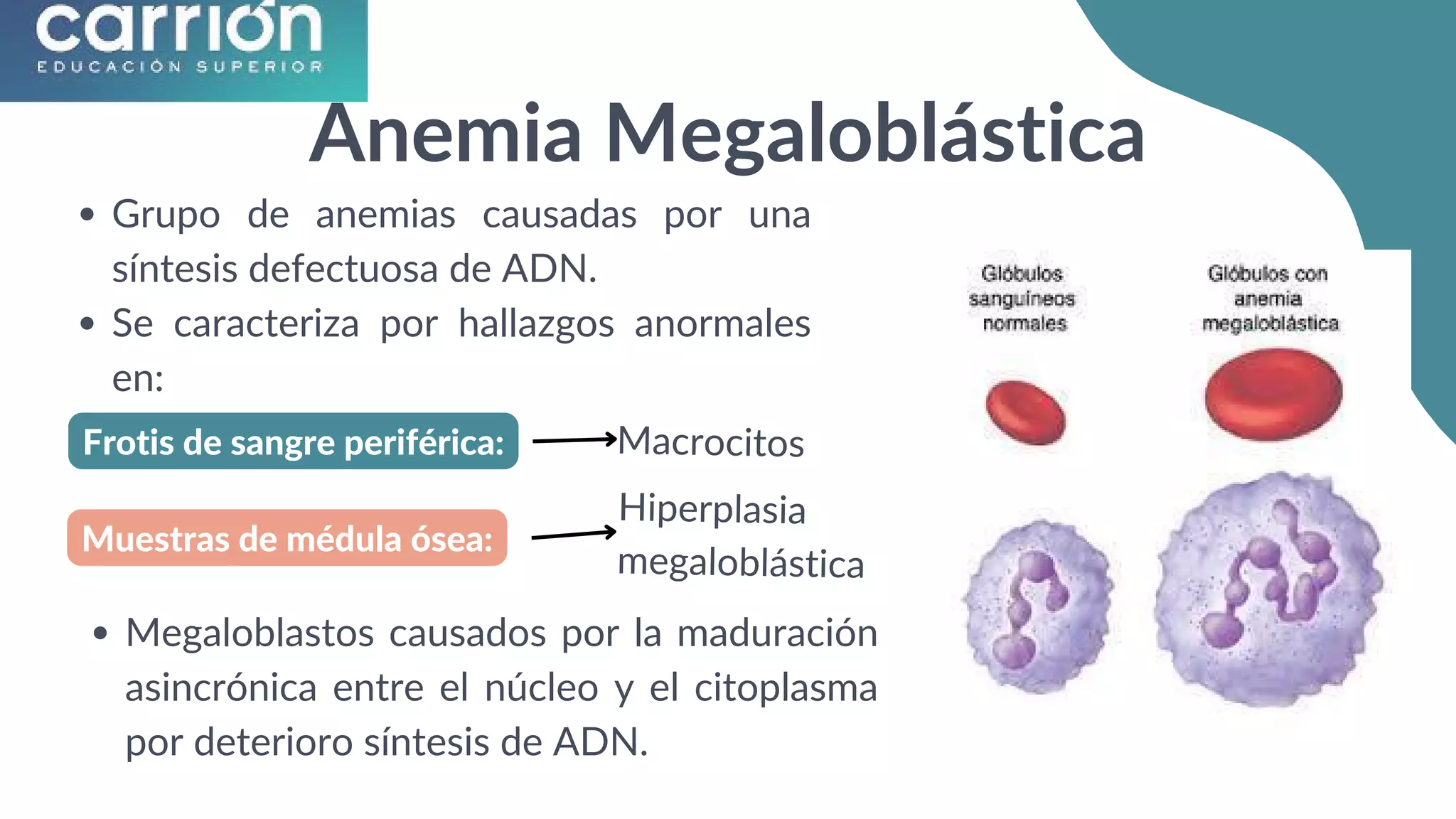 Anemia por déficit de vitamina b12 y Ácido fólico | PDF