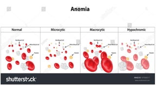 Anemia ppt | PPT