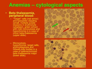 Anemias | PPT