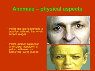 Anemias | PPT