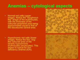 Anemias | PPT