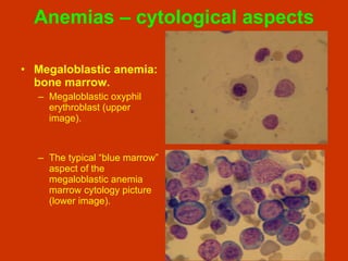 Anemias | PPT