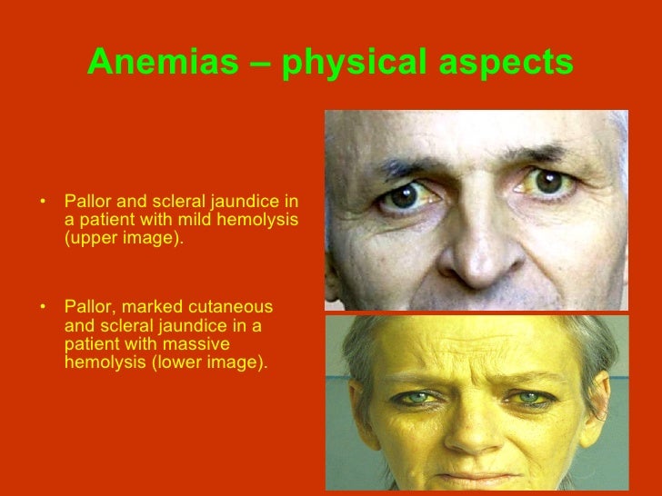 Anemias