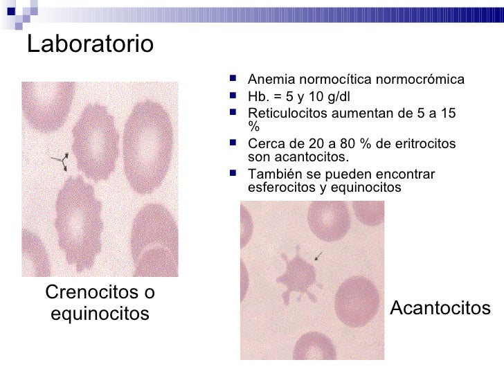 Anemias defectos extrinsecos 2