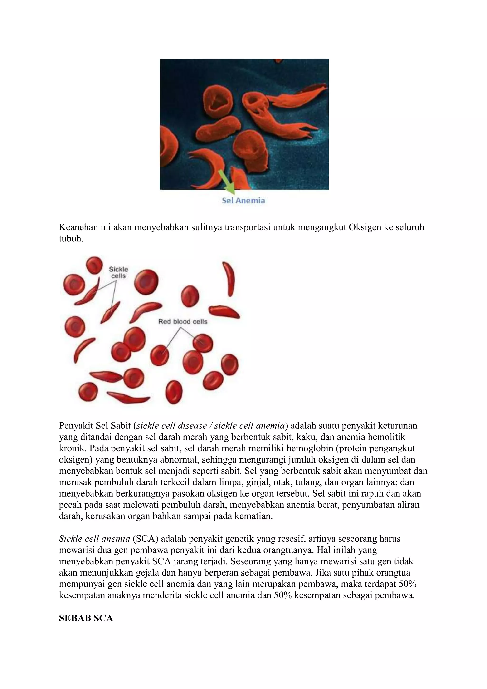 Anemia sel sabit | PDF