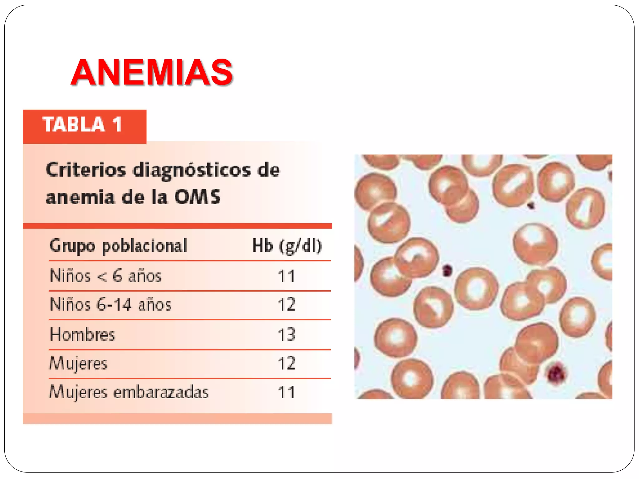 Anemias HEMOLÍTICA.ppt