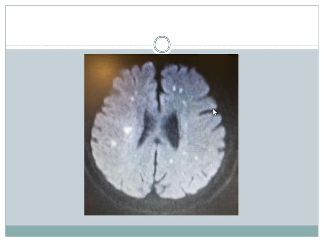 Anemia and Stroke | PPTX | Blood Disorders | Diseases and Conditions
