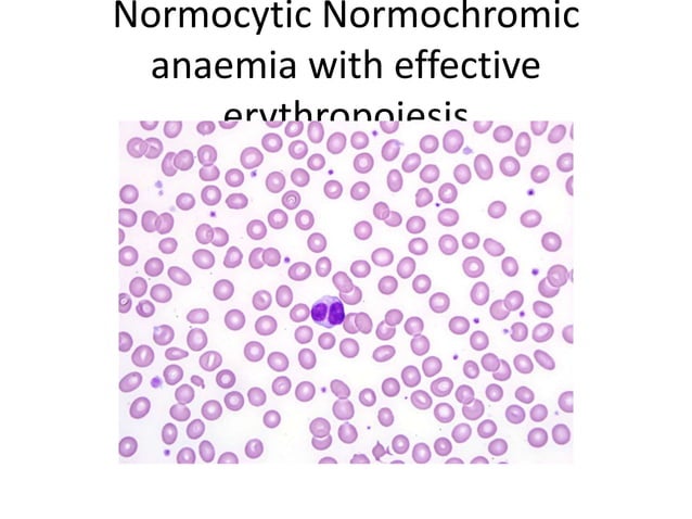 Anemia Up To Date Classification And Diagnosis Pptx Free Download