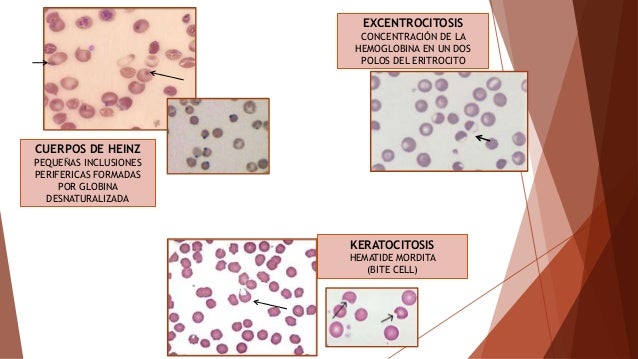 Anemina por deficiencia g6 pd (anemia hemolitica) fernanda rafalski y…