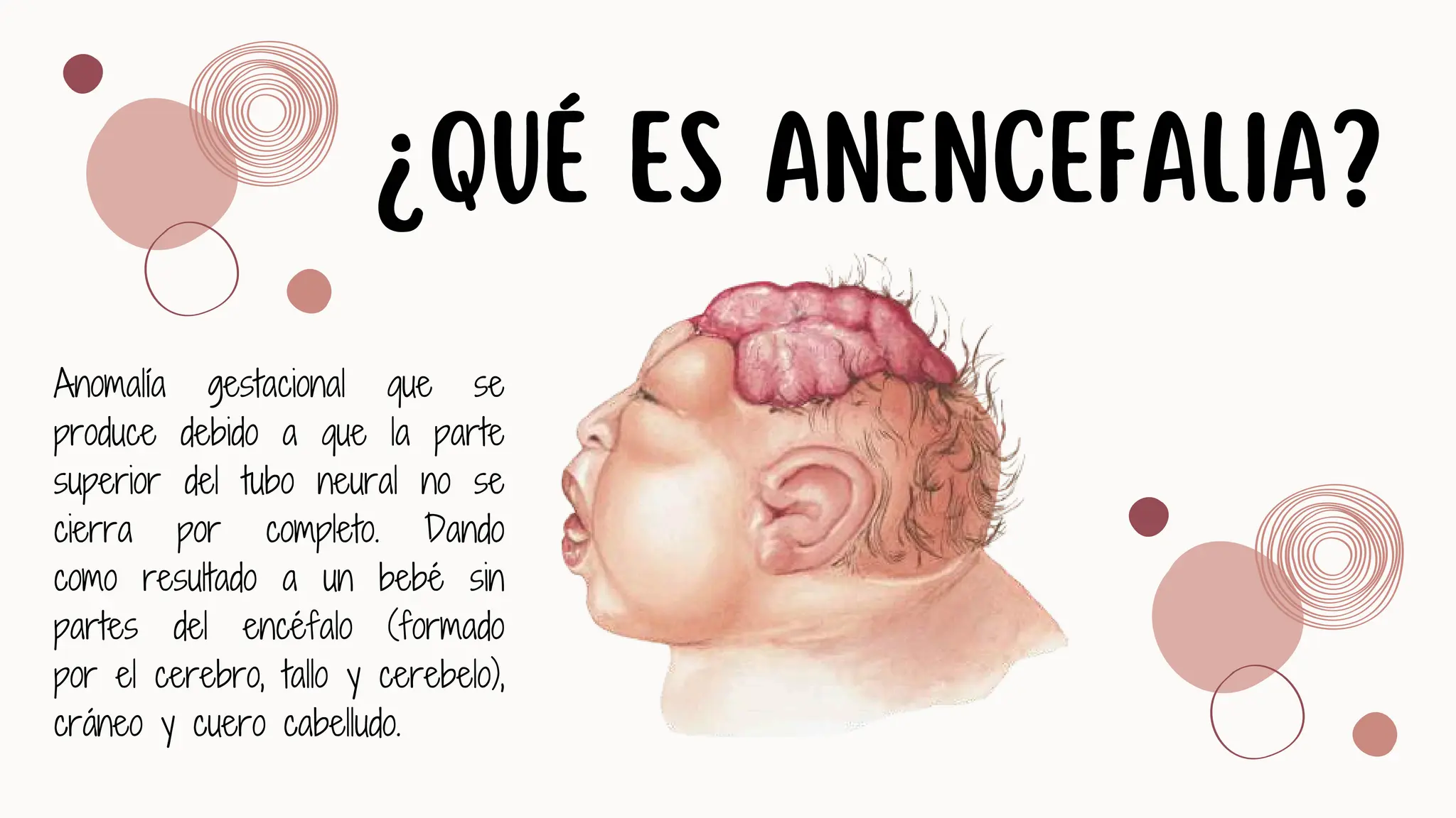 anencefalia.pdf embriologia anencefalia | PDF