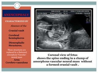 Anencephaly | PPTX