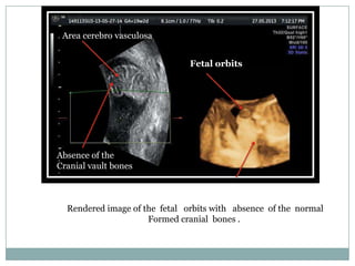Anencephaly | PPTX