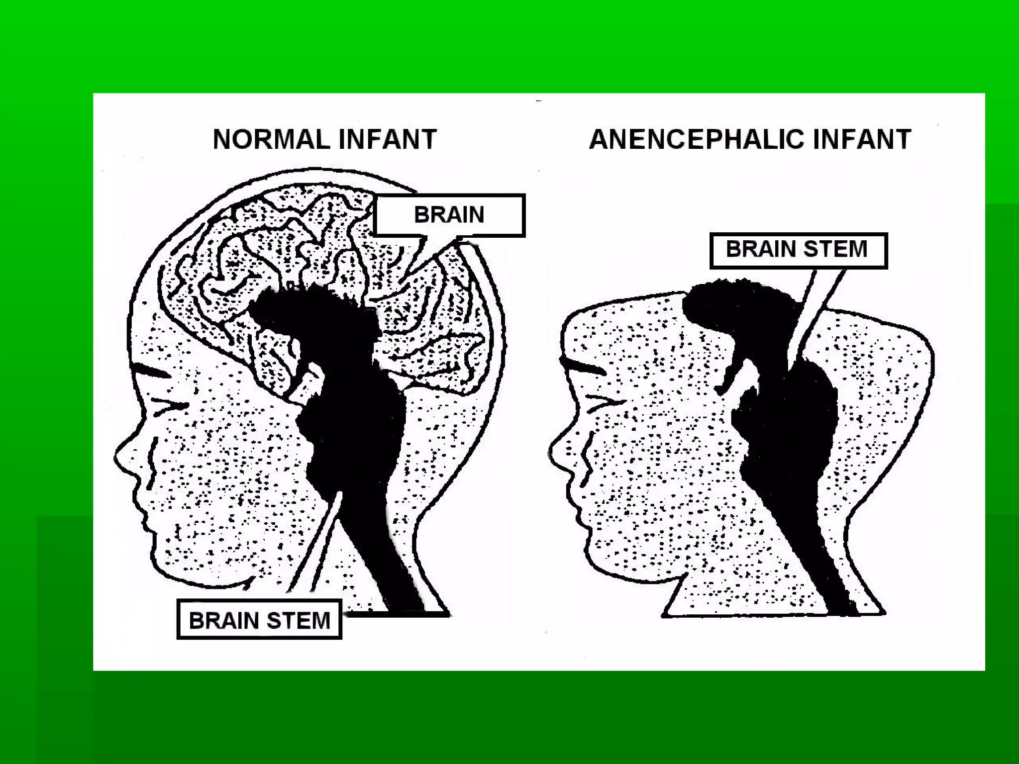 Anencephaly ppt | PPT