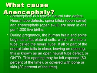 Anencephaly ppt | PPT