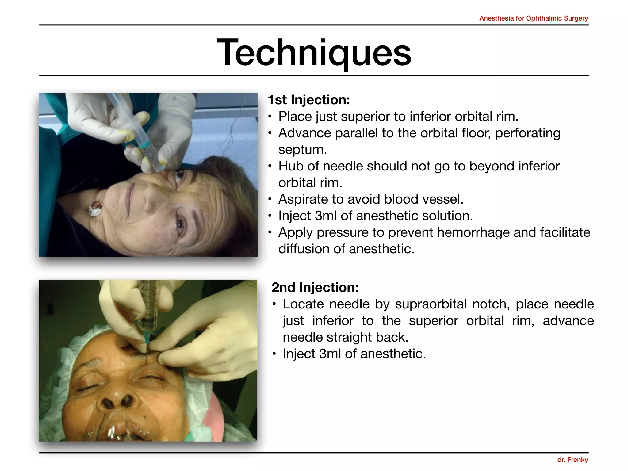 Anesthesia for Ophthalmic Surgery | PDF