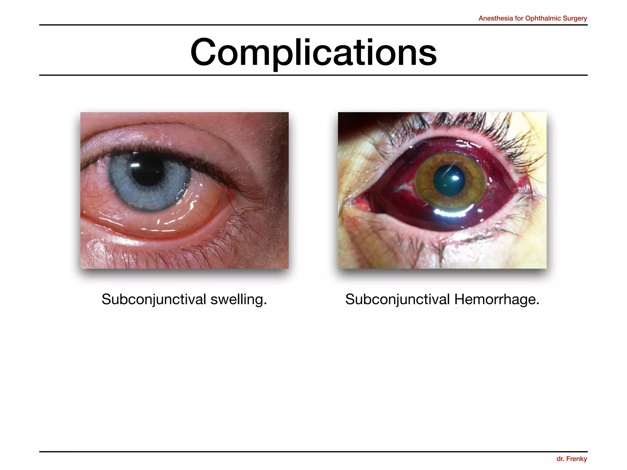 Anesthesia for Ophthalmic Surgery | PDF