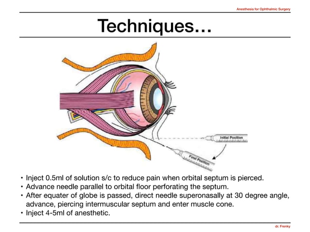 Anesthesia for Ophthalmic Surgery | PDF