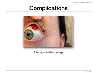 Anesthesia for Ophthalmic Surgery | PDF