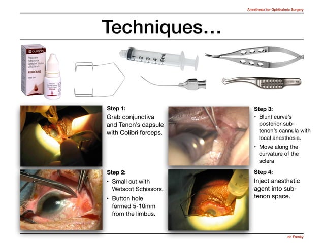 Anesthesia for Ophthalmic Surgery | PDF