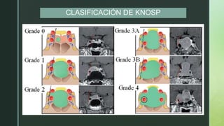 ANESTESIA EN CIRUGÍA DE HIPÓFISIS.pptx