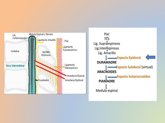 Anestesia Regional Epidural 202400pptx