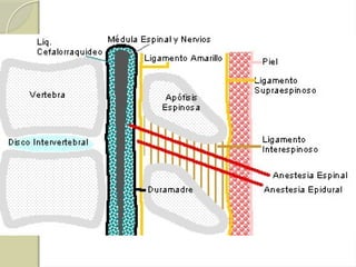 ANESTESIA RAQUIDEA ESPINAL LOCAL Y RAQUI.pptx