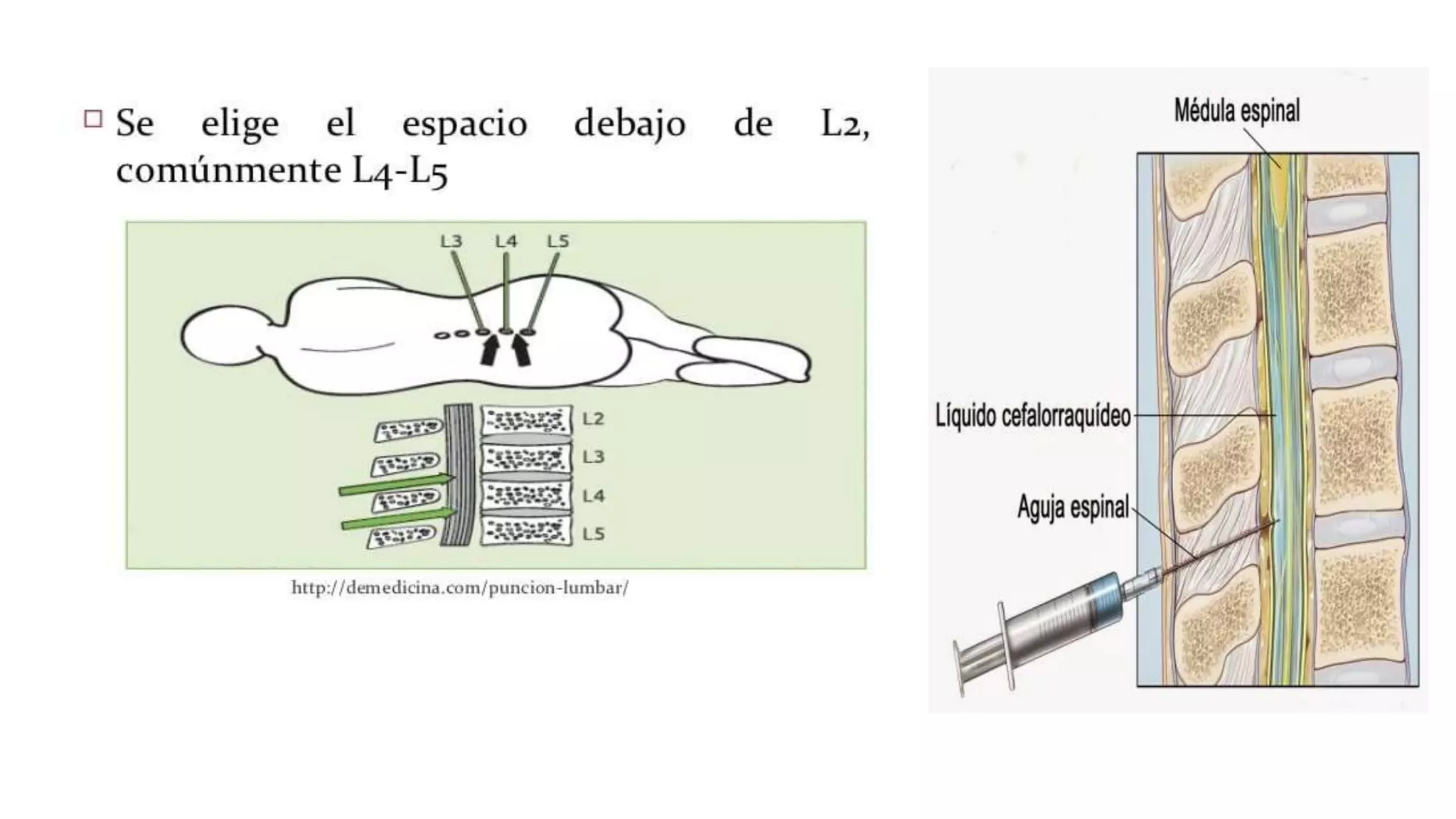 ANESTESIA RAQUIDEA Y EPIDURAL.pptx | Surgery | Medical Health