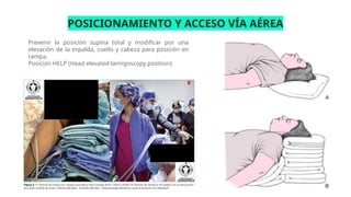 ANESTESIA Y VÍA AÉREA EN PACIENTE OBESO.pptx
