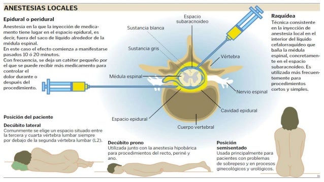 Anestesia raquidea, epidural y caudal