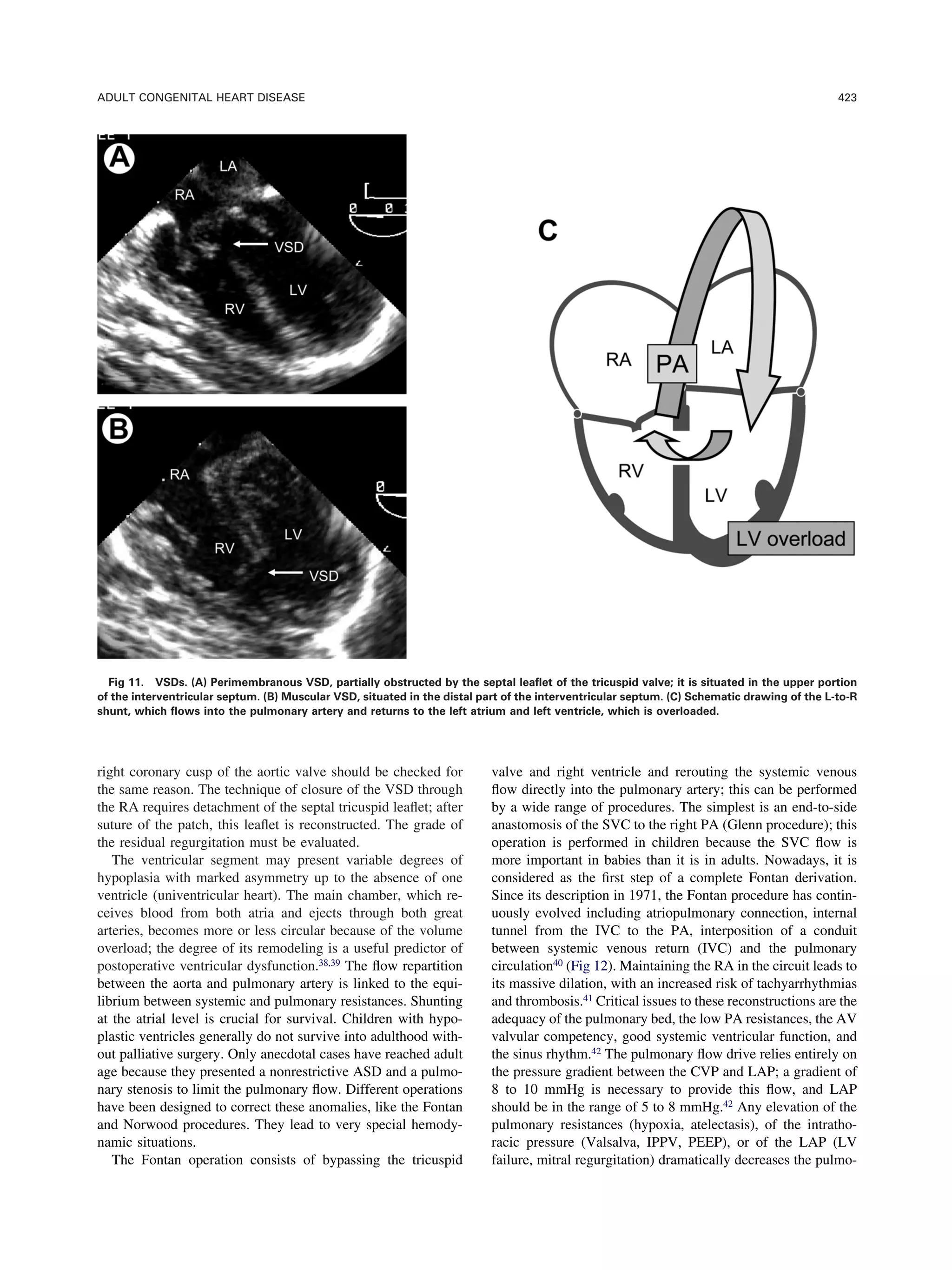 Anesthesia And Congenital Heart Disease | PDF