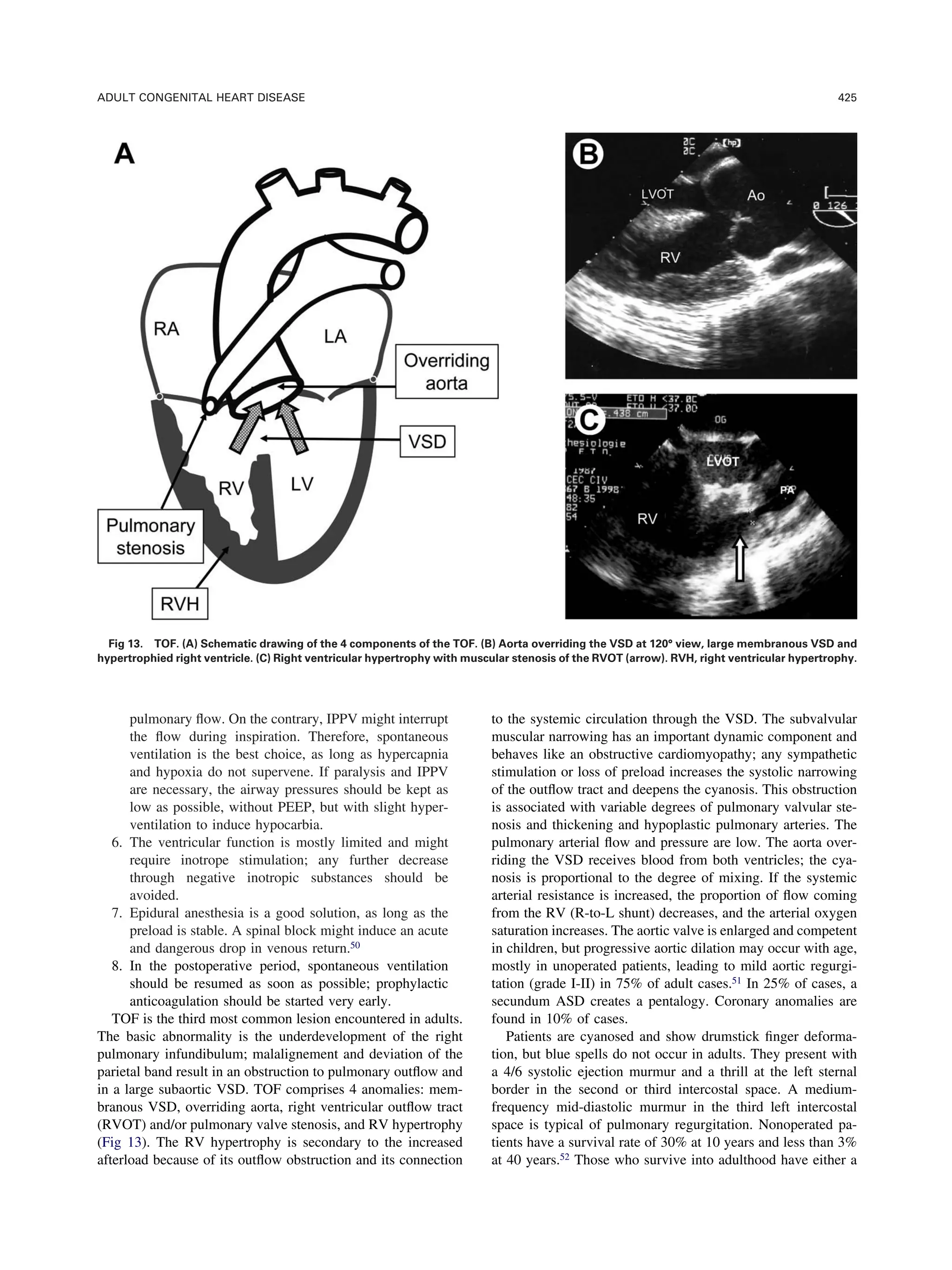 Anesthesia And Congenital Heart Disease | PDF