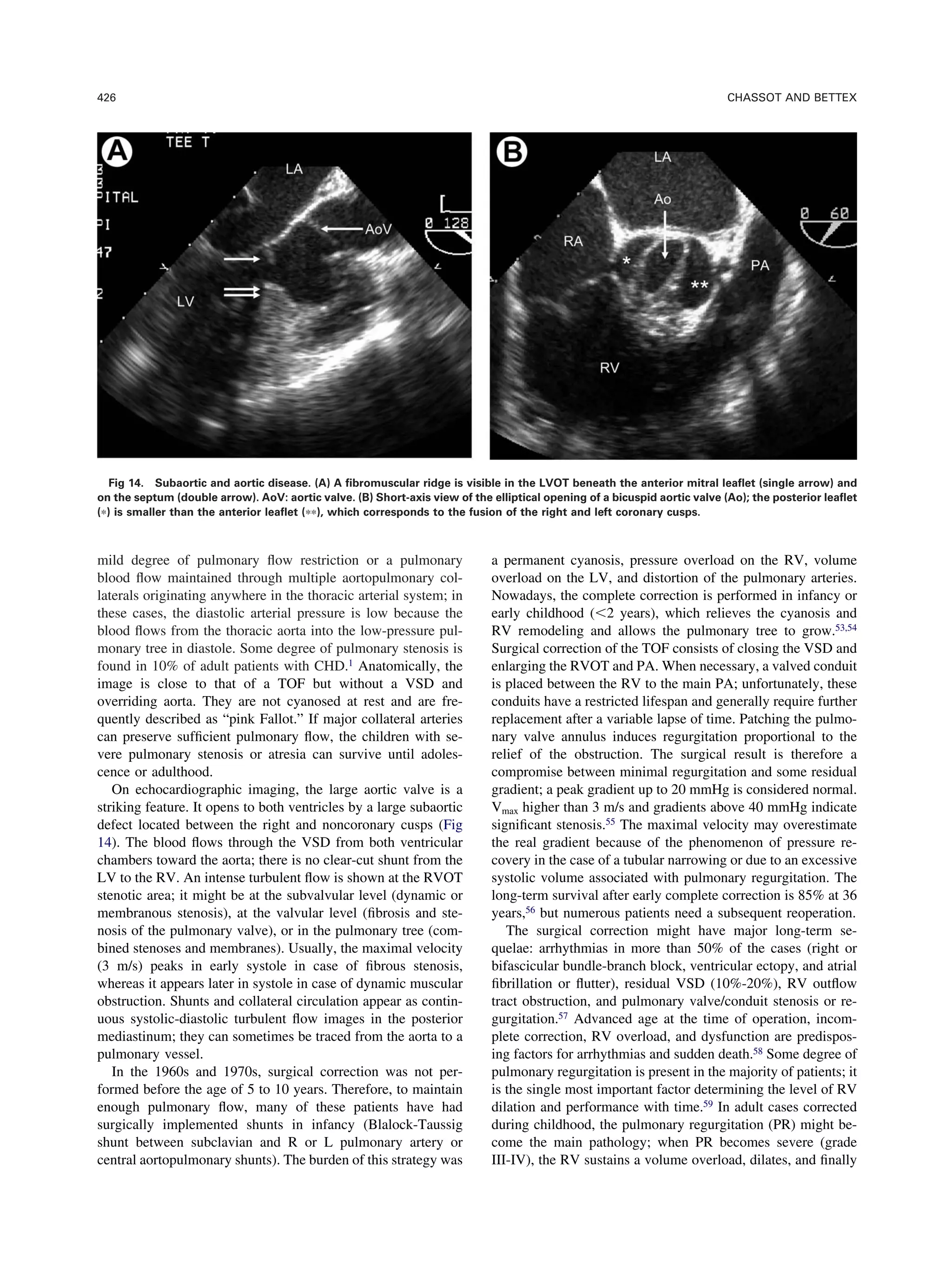 Anesthesia And Congenital Heart Disease | PDF