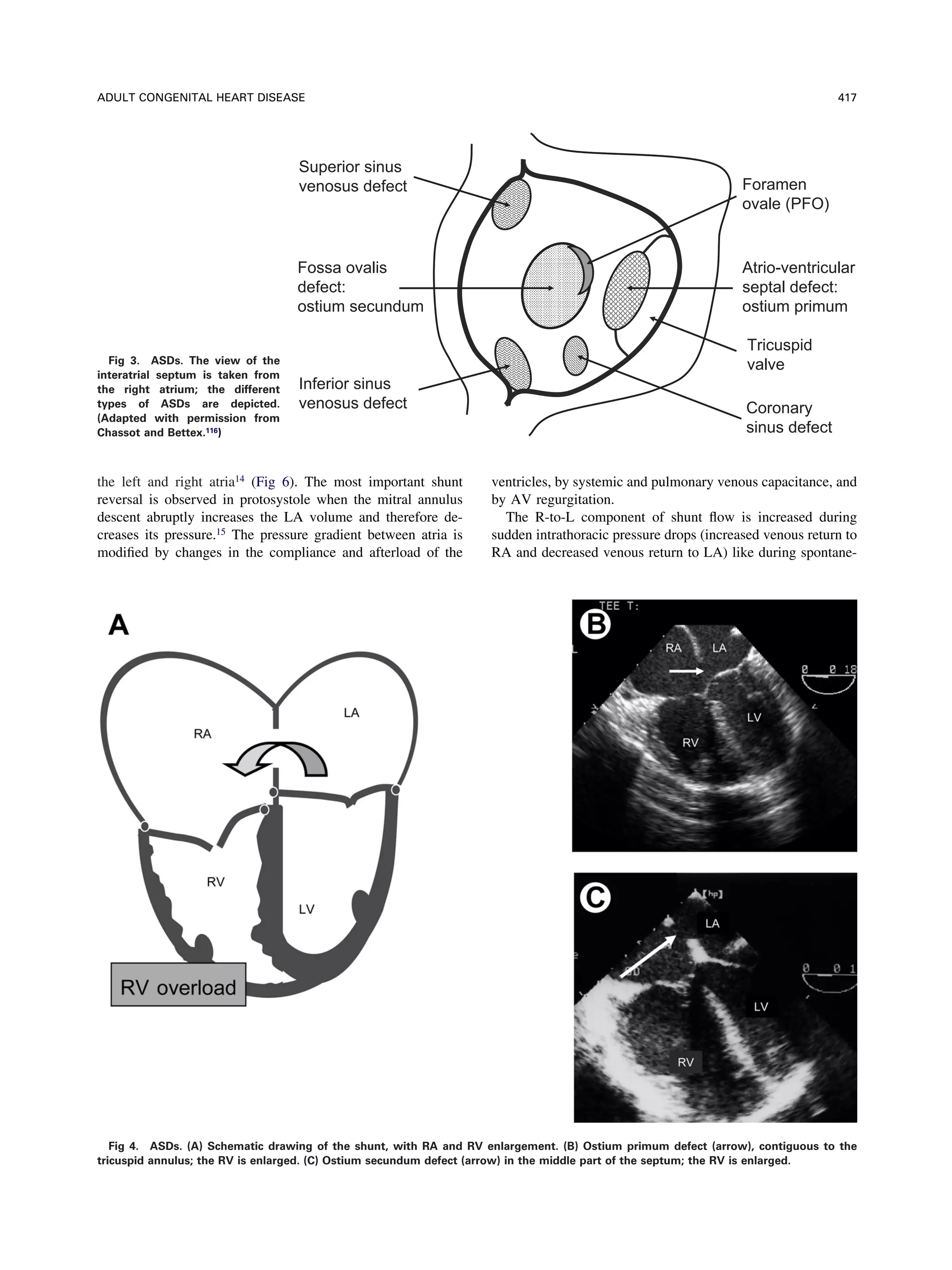 Anesthesia And Congenital Heart Disease | PDF