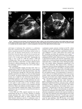 Anesthesia And Congenital Heart Disease | PDF