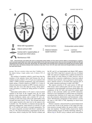 Anesthesia And Congenital Heart Disease | PDF