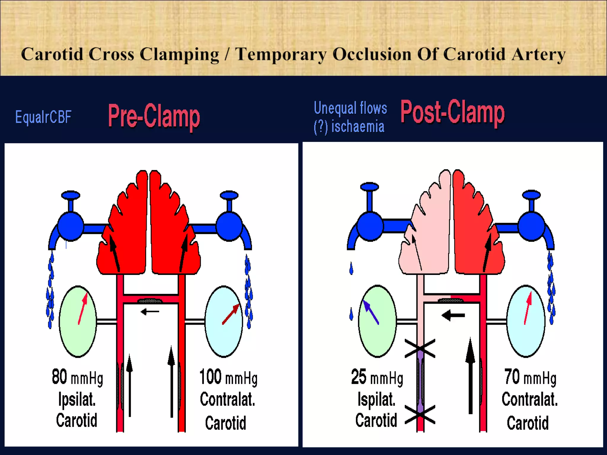 Anesthesia for-carotid-endarterectomy | PPT