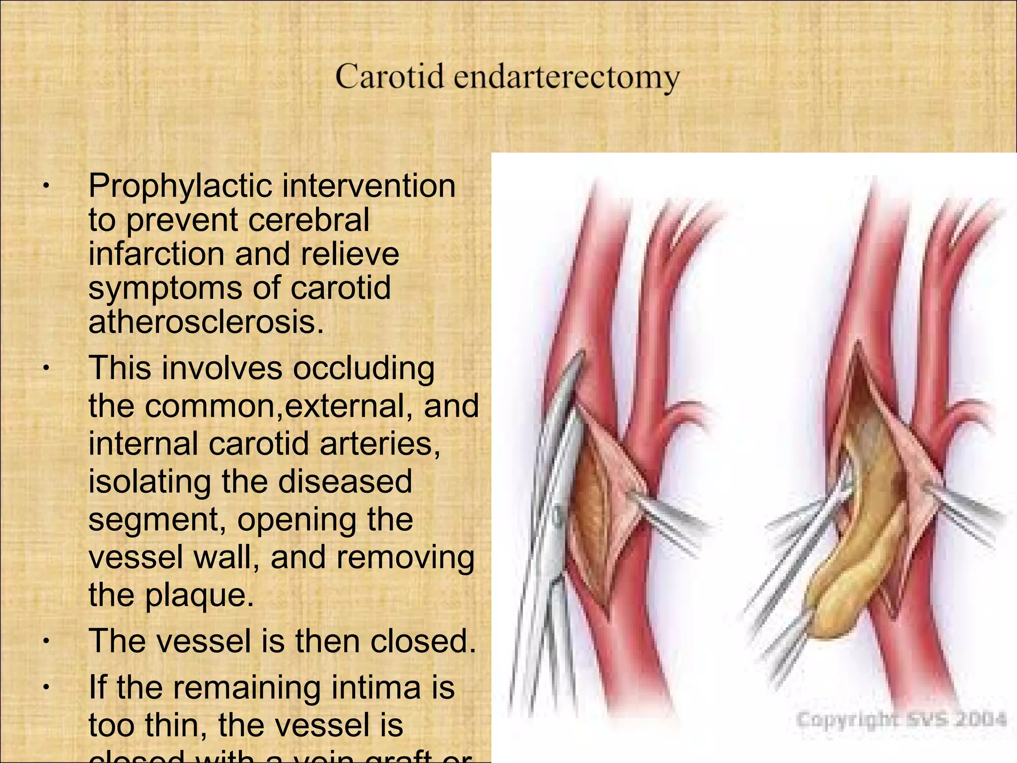 Anesthesia for-carotid-endarterectomy | PPT