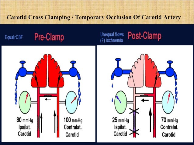 Anesthesia for-carotid-endarterectomy