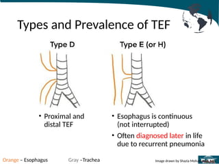 Anesthesia-for-Tracheoesophageal-Fistula-Repair | PPTX