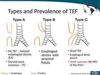 Anesthesia-for-Tracheoesophageal-Fistula-Repair | PPTX