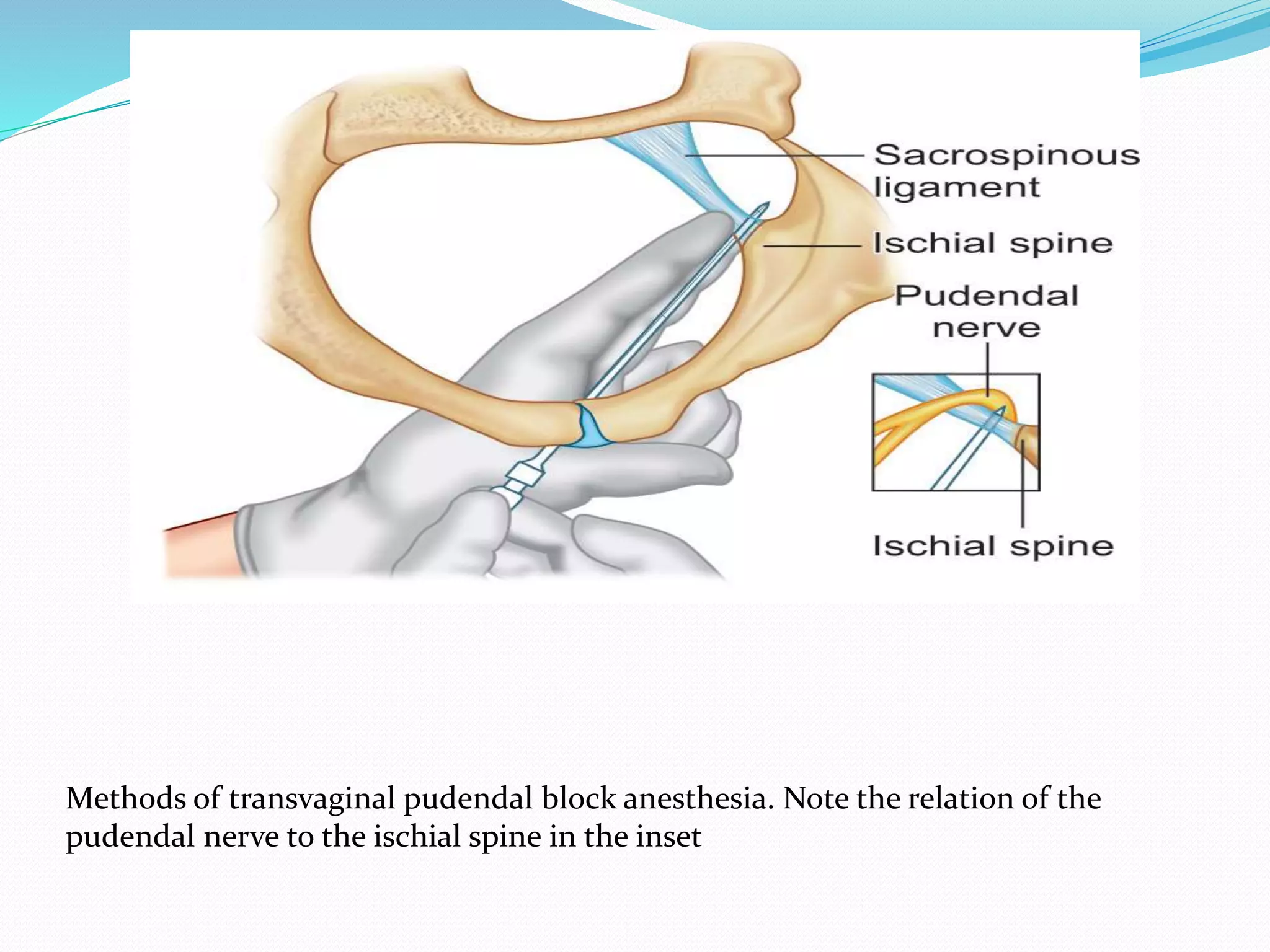 Anesthesia and analgesia in obstetrics.pptx