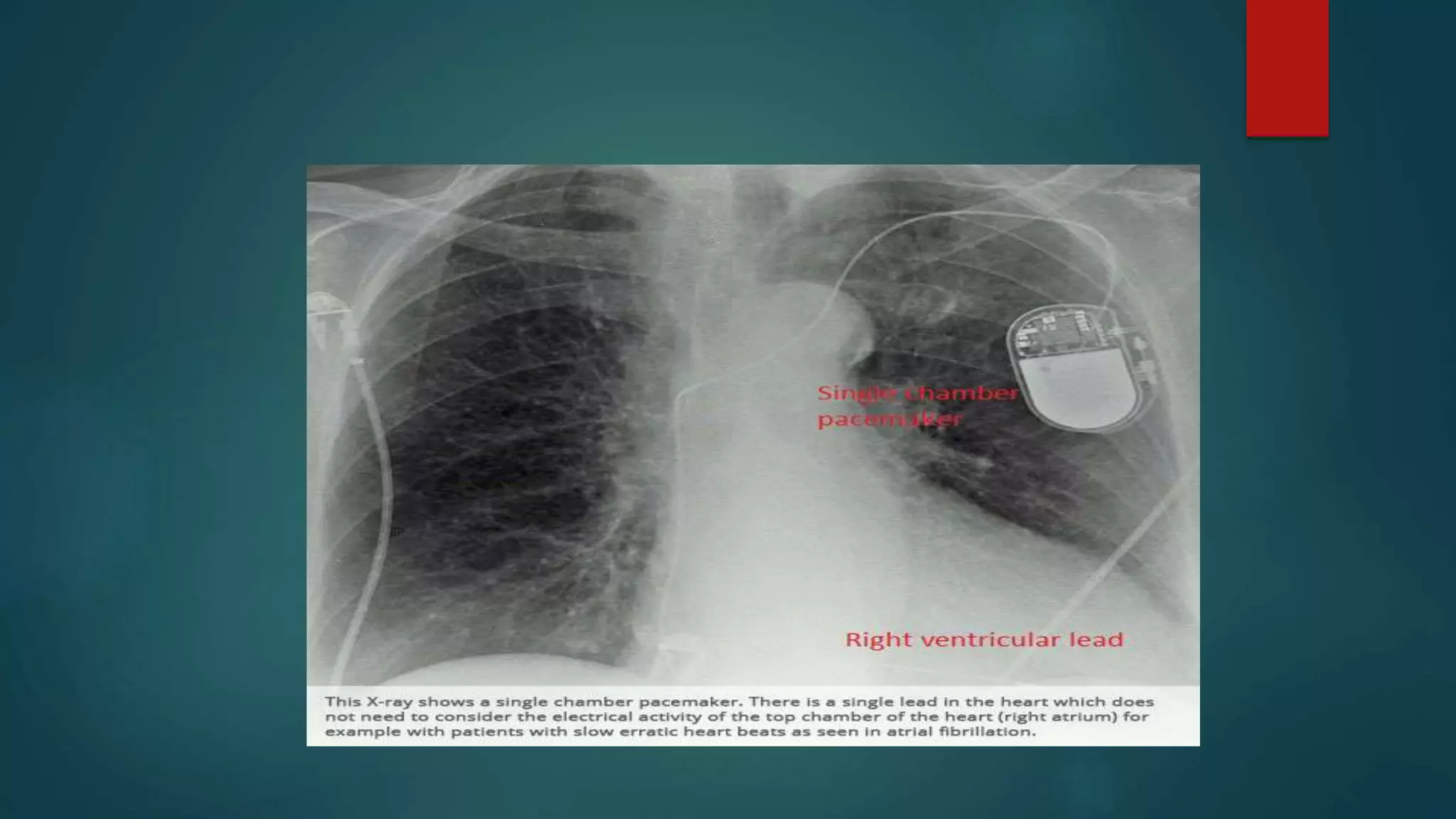 Anesthesia and cardiac pacemaker | PPTX