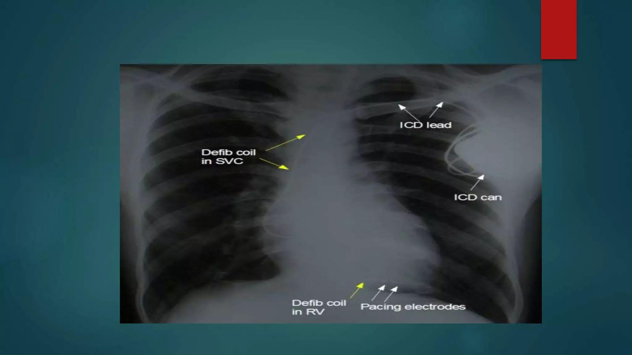 Anesthesia and cardiac pacemaker | PPTX