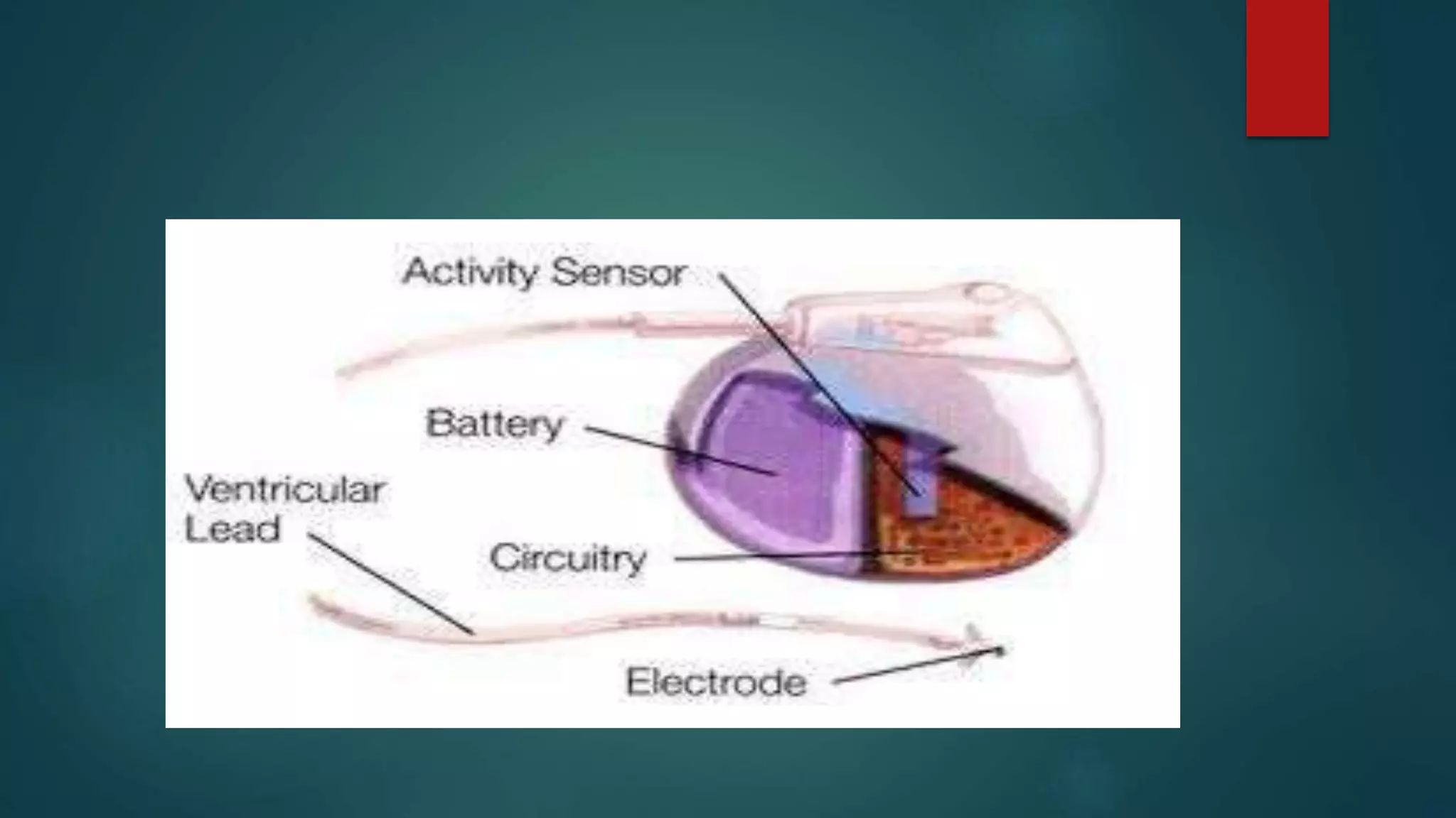 Anesthesia and cardiac pacemaker | PPTX