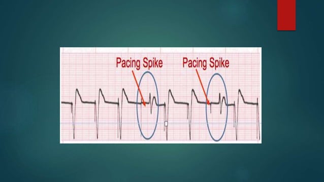 Anesthesia and cardiac pacemaker | PPTX