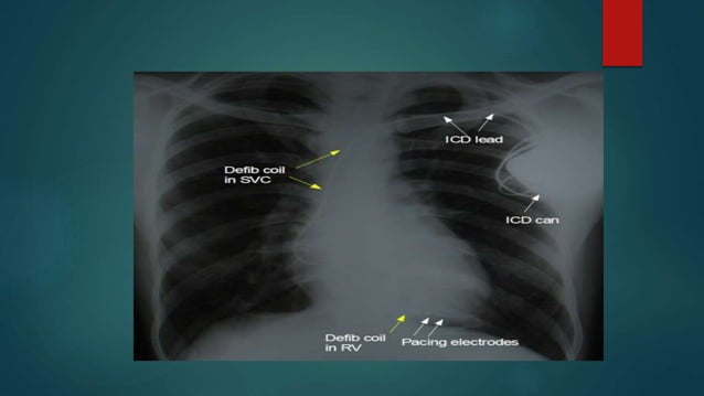 Anesthesia and cardiac pacemaker | PPTX