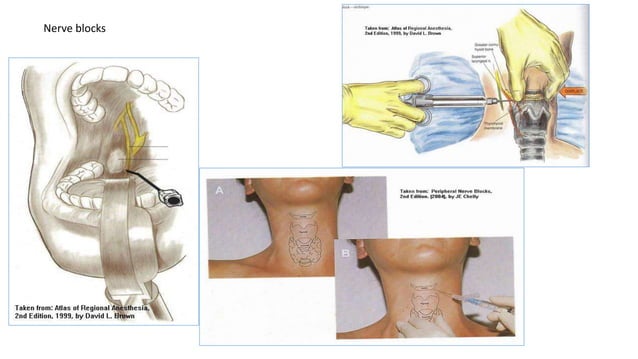 Anesthesia and sedation during flexible bronchoscopy | Jindal chest ...