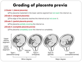 Anesthesia for ANTEPARTUM HAEMORHHAGE (APH) | PPTX